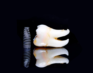 Zygomatic implants are dental implants